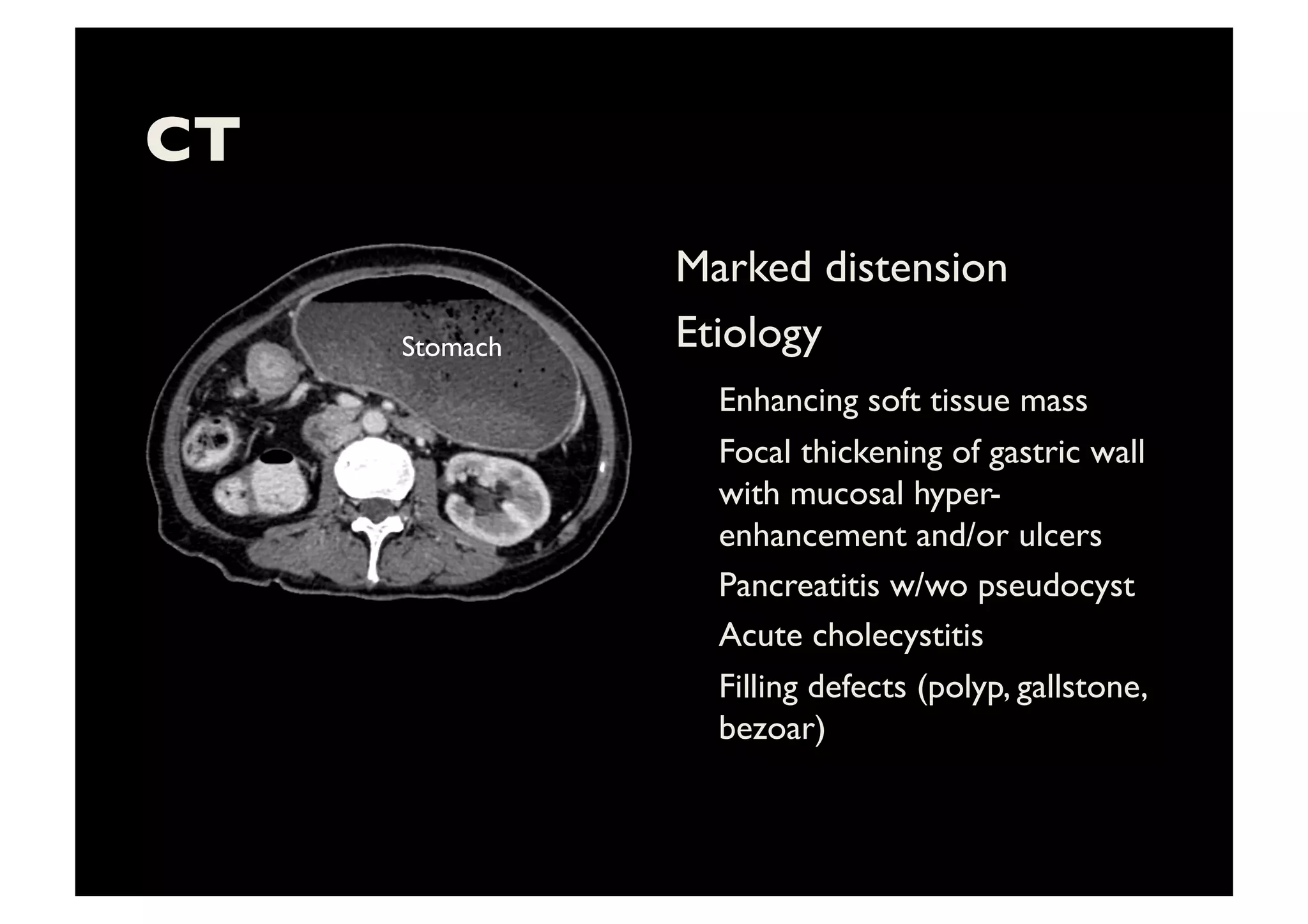 Imaging of Bowel Obstruction | PDF