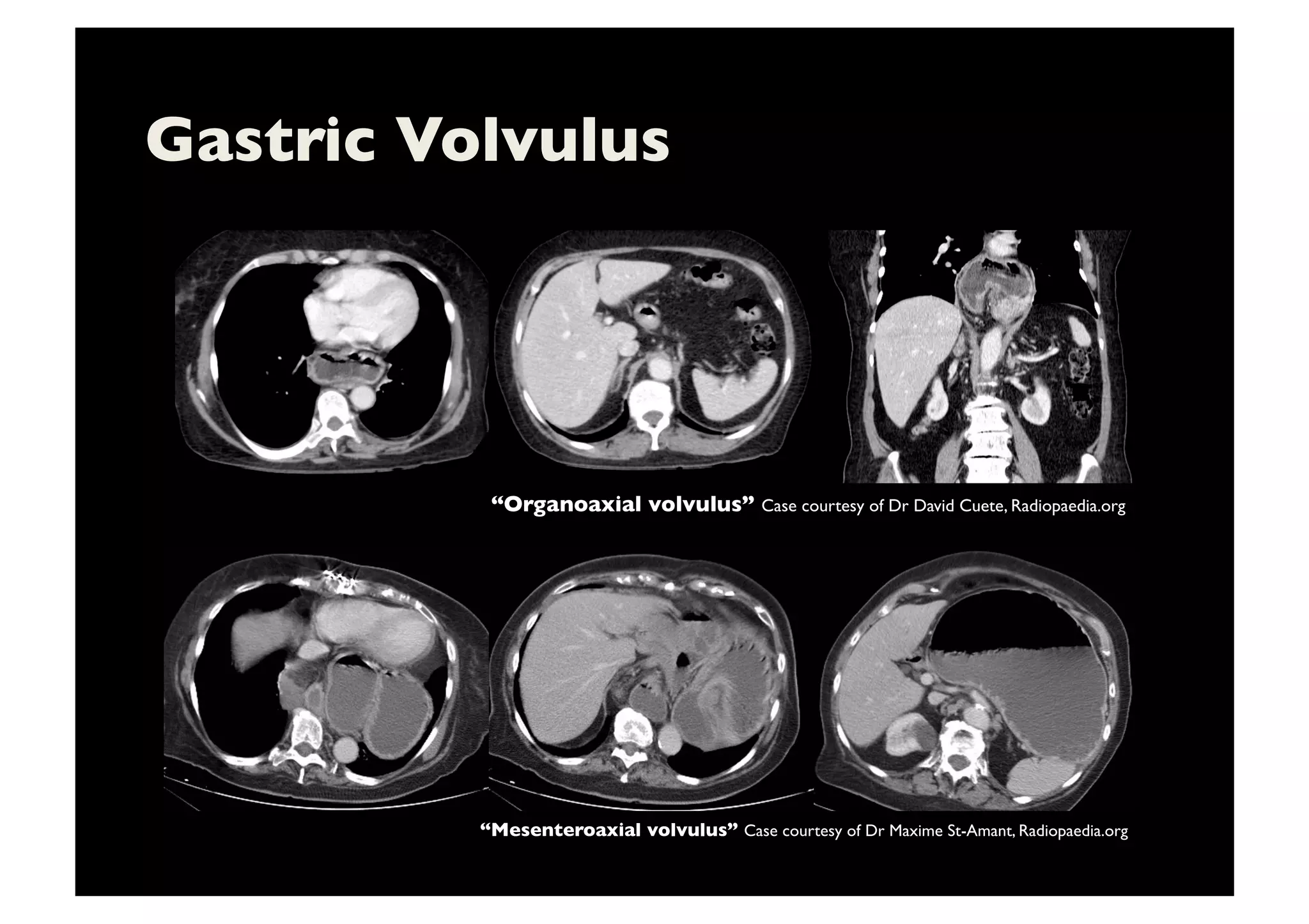 Imaging of Bowel Obstruction | PDF
