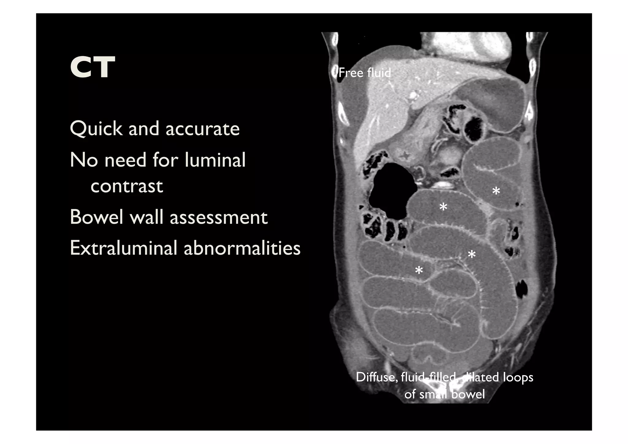 Imaging of Bowel Obstruction | PDF