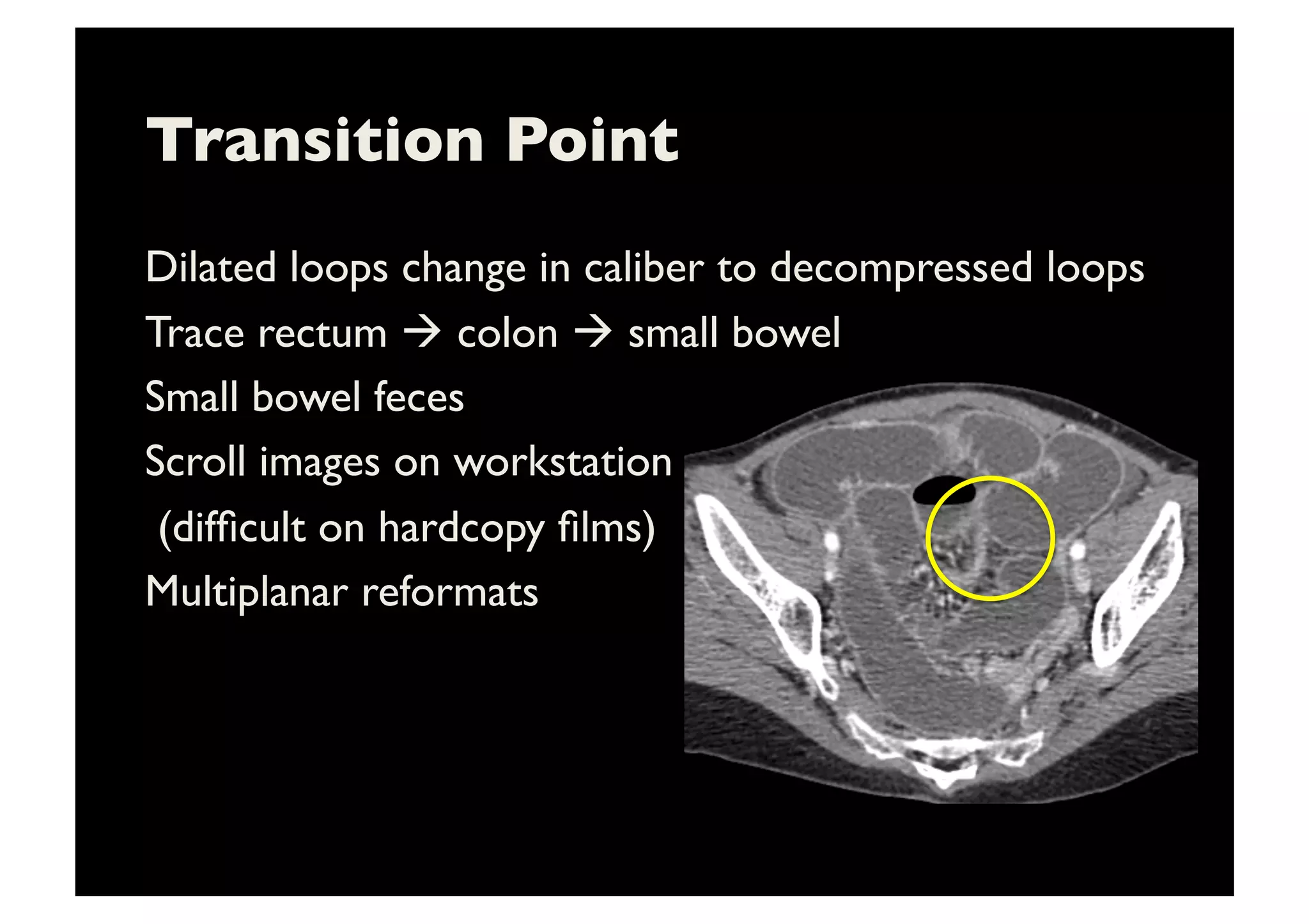 Imaging of Bowel Obstruction | PDF