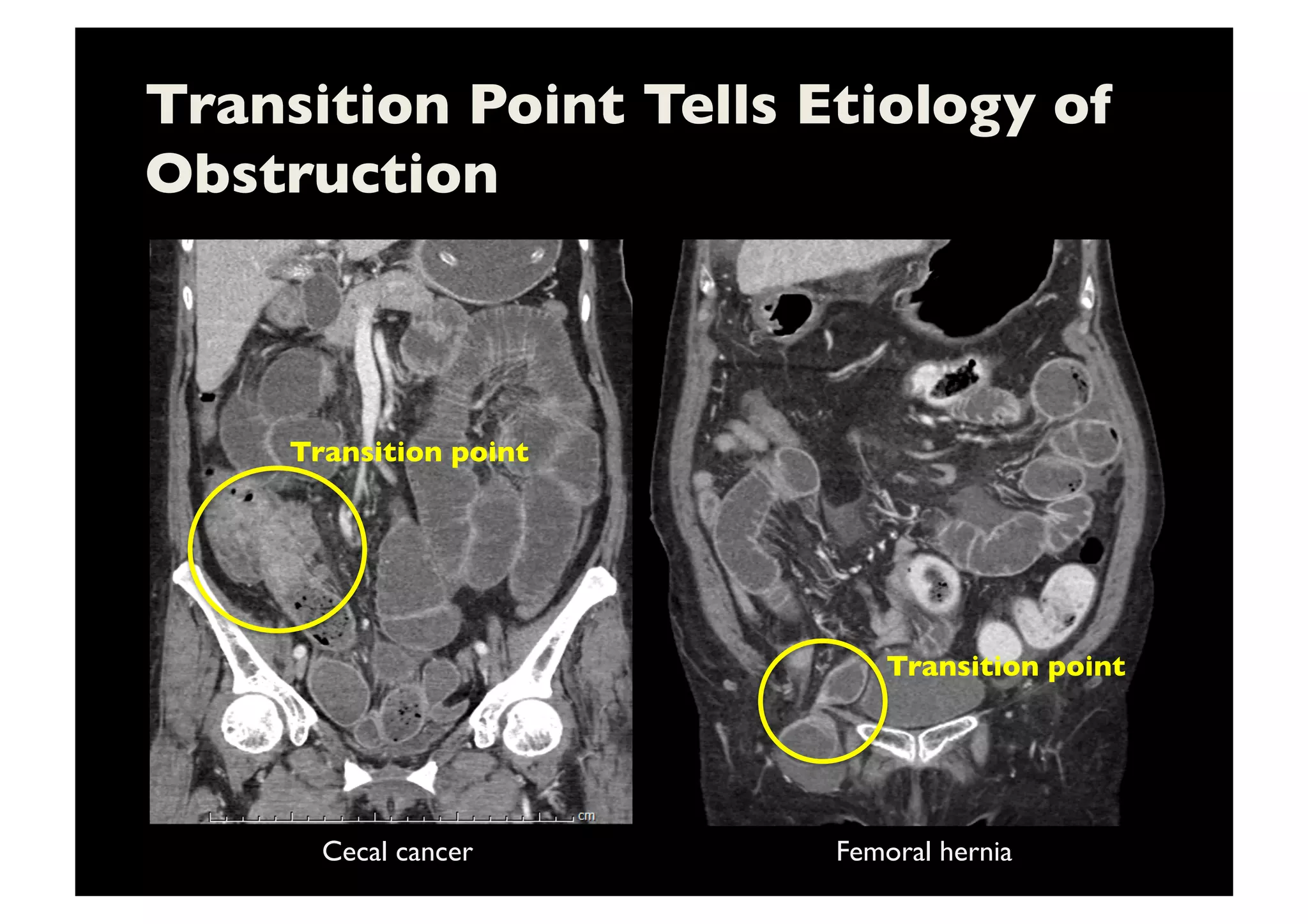 Imaging of Bowel Obstruction | PDF
