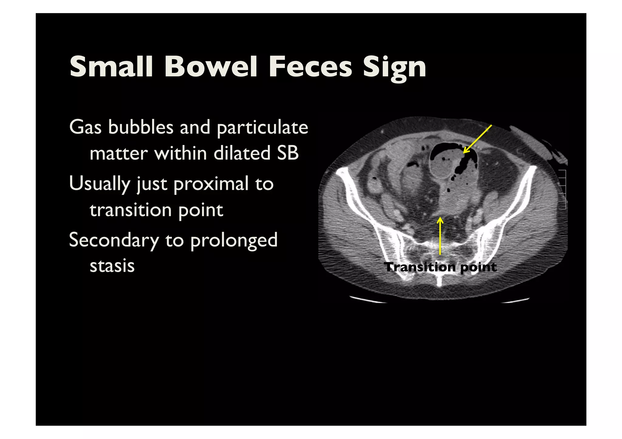 Imaging of Bowel Obstruction | PDF
