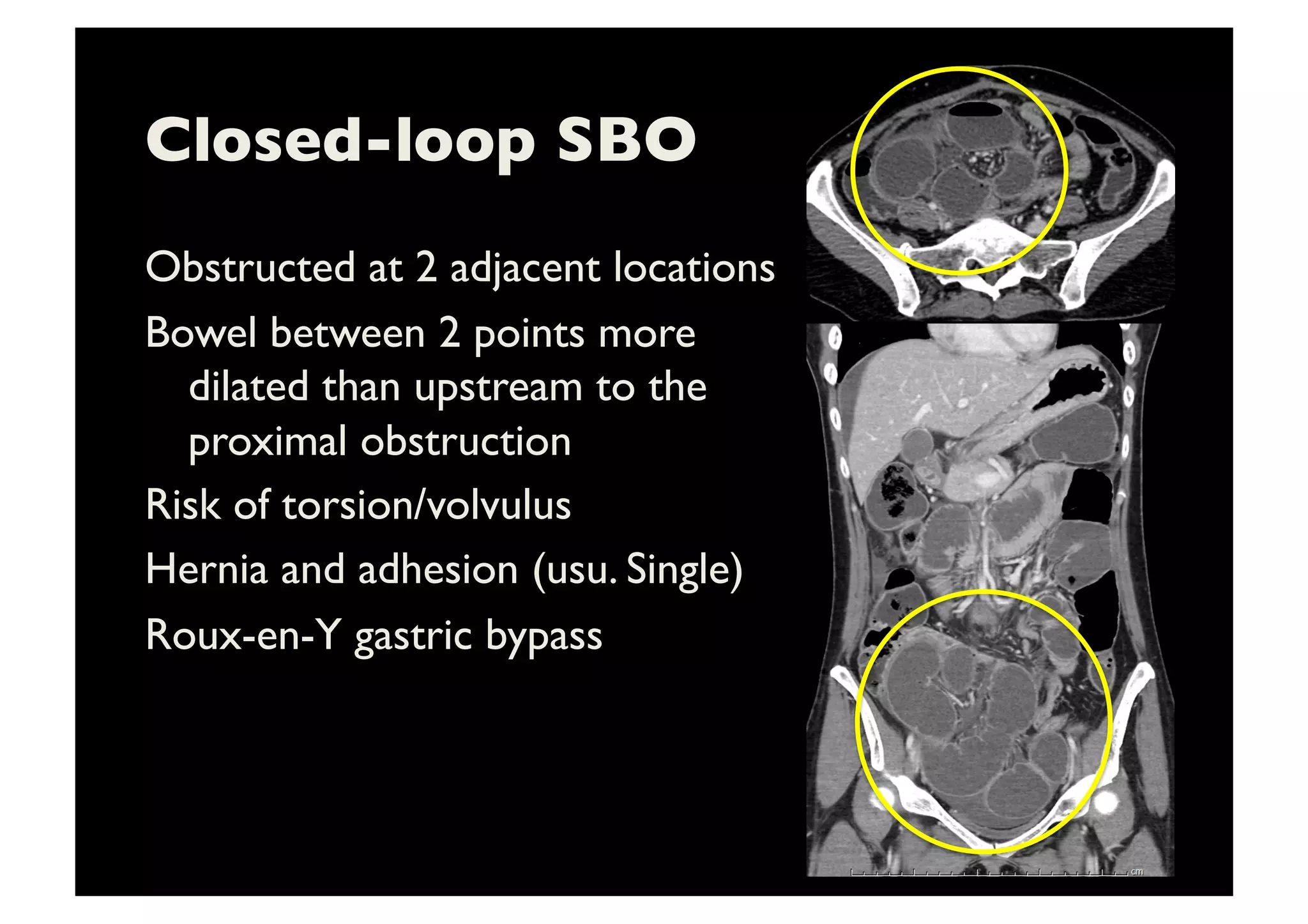 Imaging of Bowel Obstruction | PDF