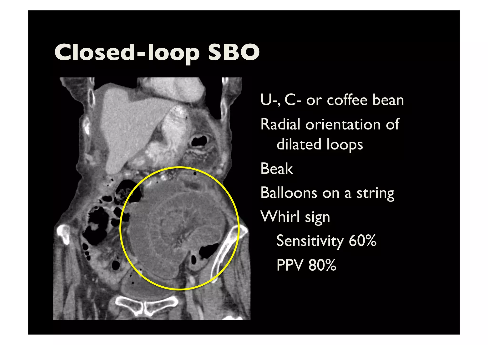 Imaging of Bowel Obstruction | PDF