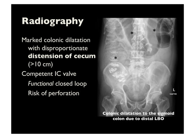 Imaging of Bowel Obstruction | PDF