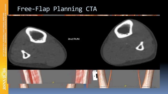 Peripheral CTA Imaging | PDF
