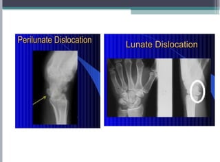 Hand pathology | PDF