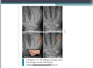 Hand pathology | PDF