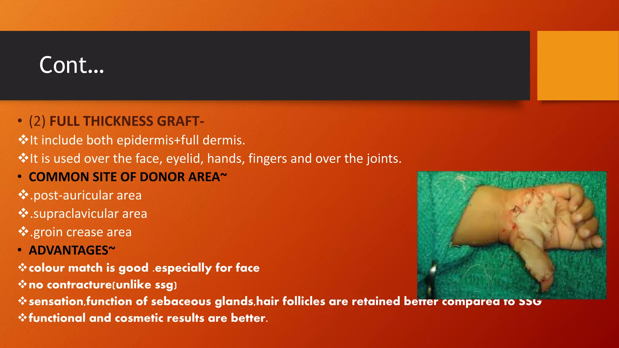 Hand reconstruction surgery & pt managment by sk | PPTX