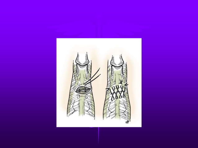 Extensor tendons injury repair and rehabilitation | PPTX