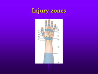 Extensor tendons injury repair and rehabilitation | PPTX