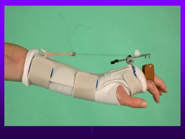 Extensor tendons injury repair and rehabilitation | PPTX