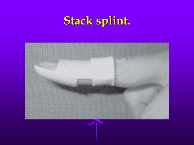 Extensor tendons injury repair and rehabilitation | PPTX