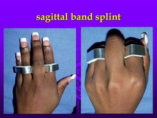 Sagittal Band Rupture Splint