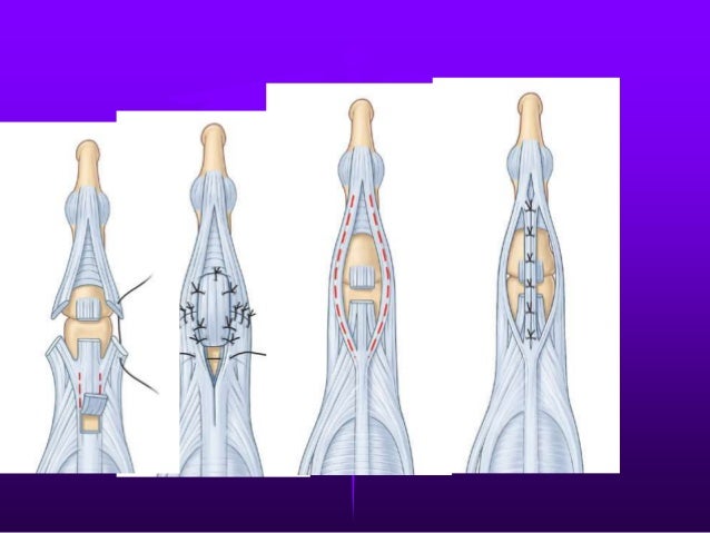 Extensor tendons injury repair and rehabilitation