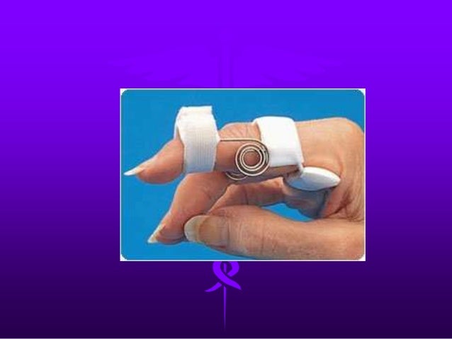 Extensor Tendon Splint