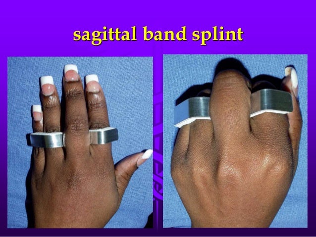 Extensor Tendon Injury Splint Extensor Tendons Injury Repair And