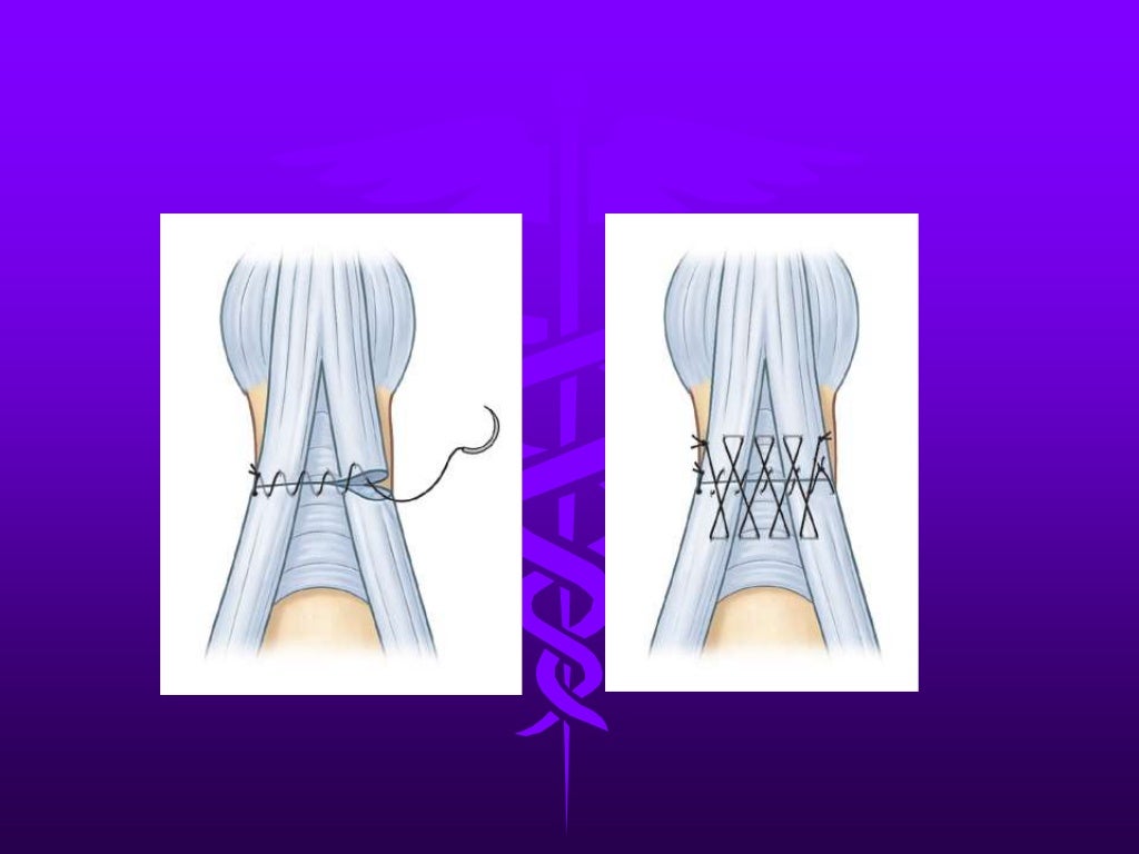 Extensor tendons injury repair and rehabilitation