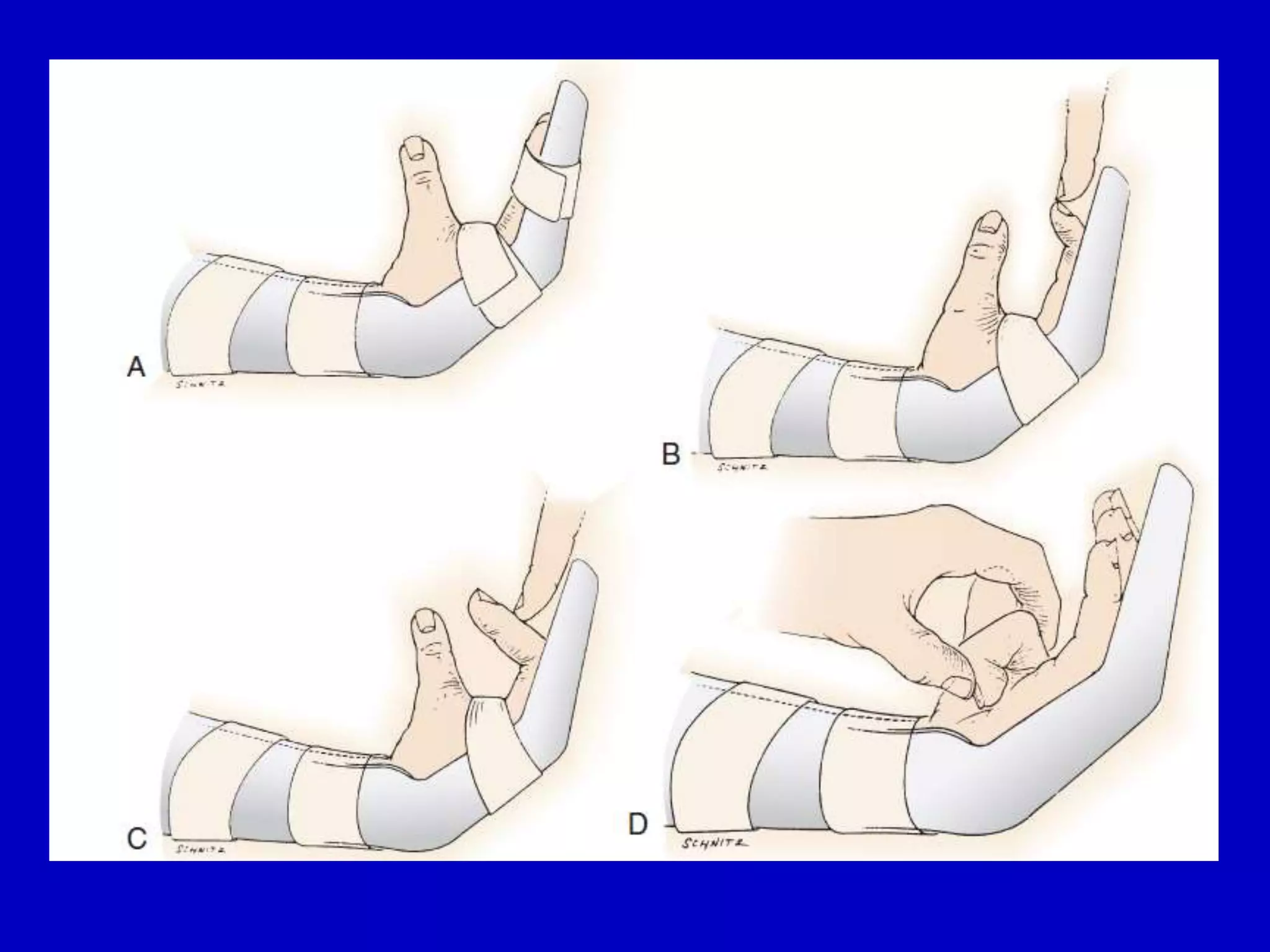 Hand rehabilitation after flexor tendon repair | PPTX