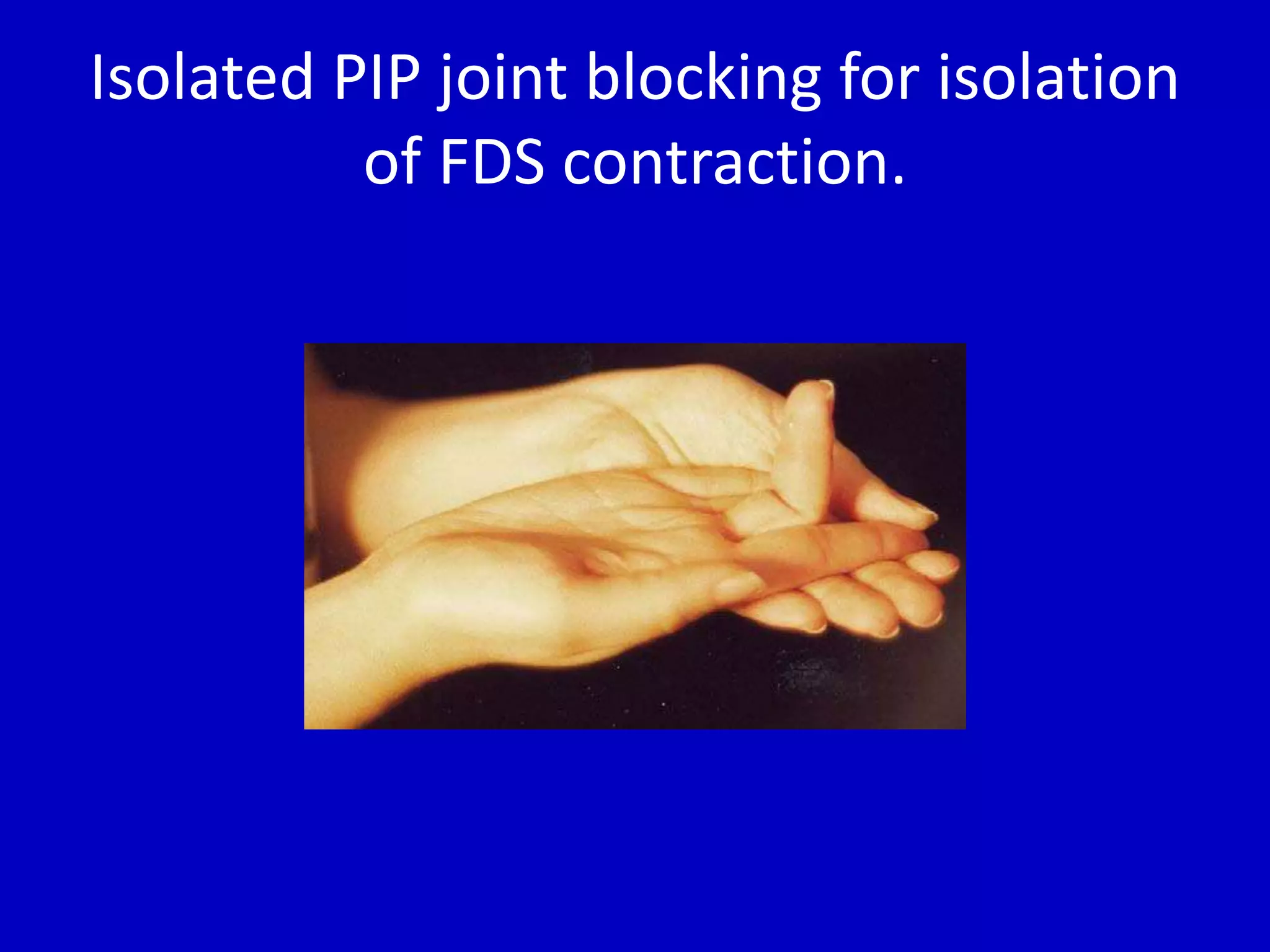 Hand rehabilitation after flexor tendon repair | PPTX