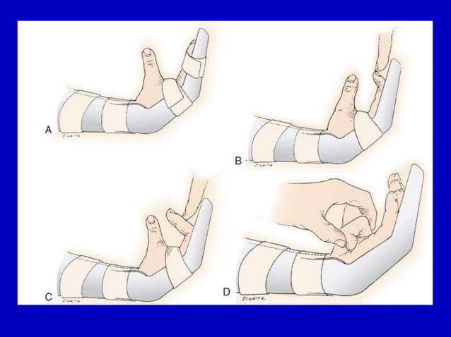 Hand rehabilitation after flexor tendon repair