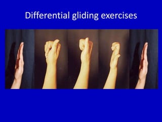 Hand rehabilitation after flexor tendon repair | PPT