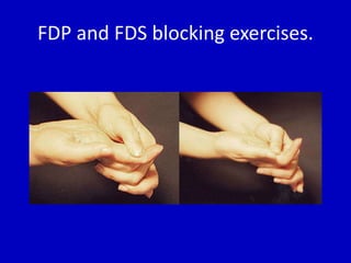 Hand rehabilitation after flexor tendon repair | PPT