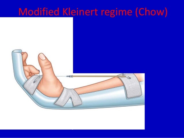 Hand rehabilitation after flexor tendon repair