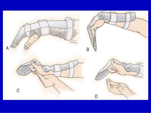Hand rehabilitation after flexor tendon repair