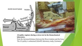 Hand rehabilitation following flexor tendon injuries | PPTX