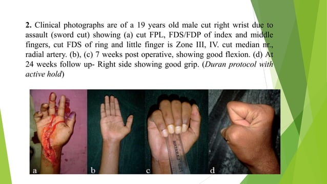 Hand rehabilitation following flexor tendon injuries | PPT