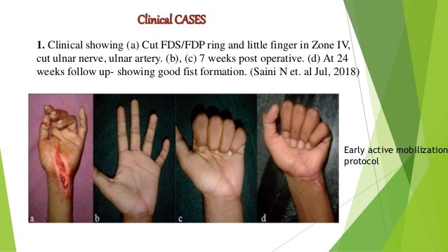 Hand rehabilitation following flexor tendon injuries