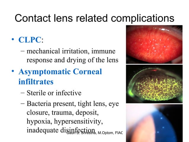 Hands on contact lens | PPT