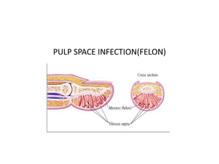 Hand spaces anatomy & infections | PPTX