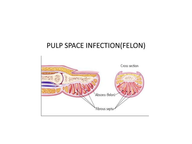 Hand spaces anatomy & infections | PPTX | Death, Injury, or Military ...