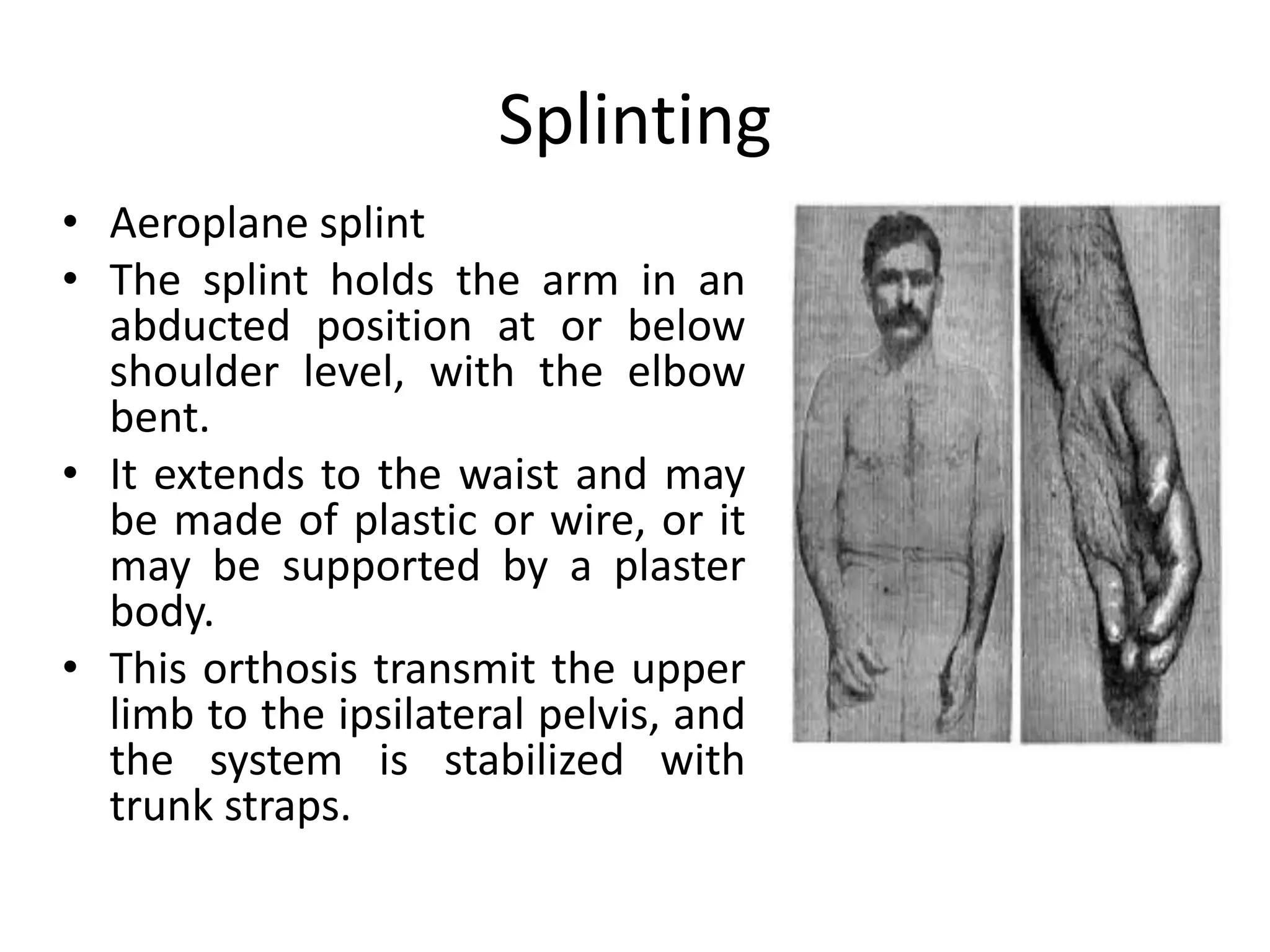 Hand splinting in common orthopedic & neurological condition 1 | PPTX