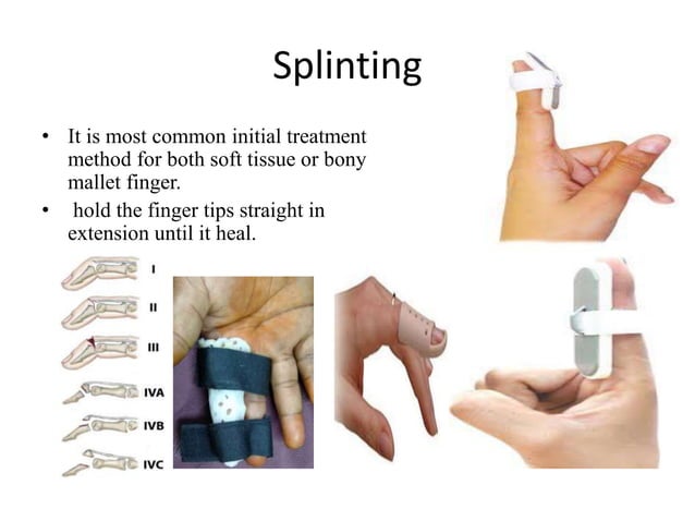 Hand splinting in common orthopedic & neurological condition 1 | PPTX