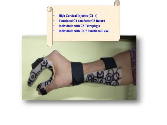 Hand splinting in common orthopedic & neurological condition 1 | PPTX