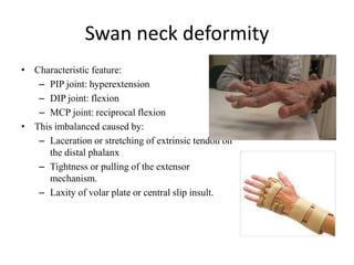 Bishops Hand Deformity