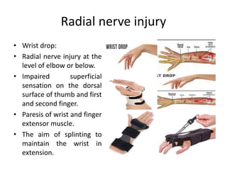 Median Nerve Palsy Splint