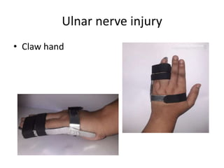 Ulnar Nerve Injury Splint