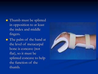 Hand splints | PPT