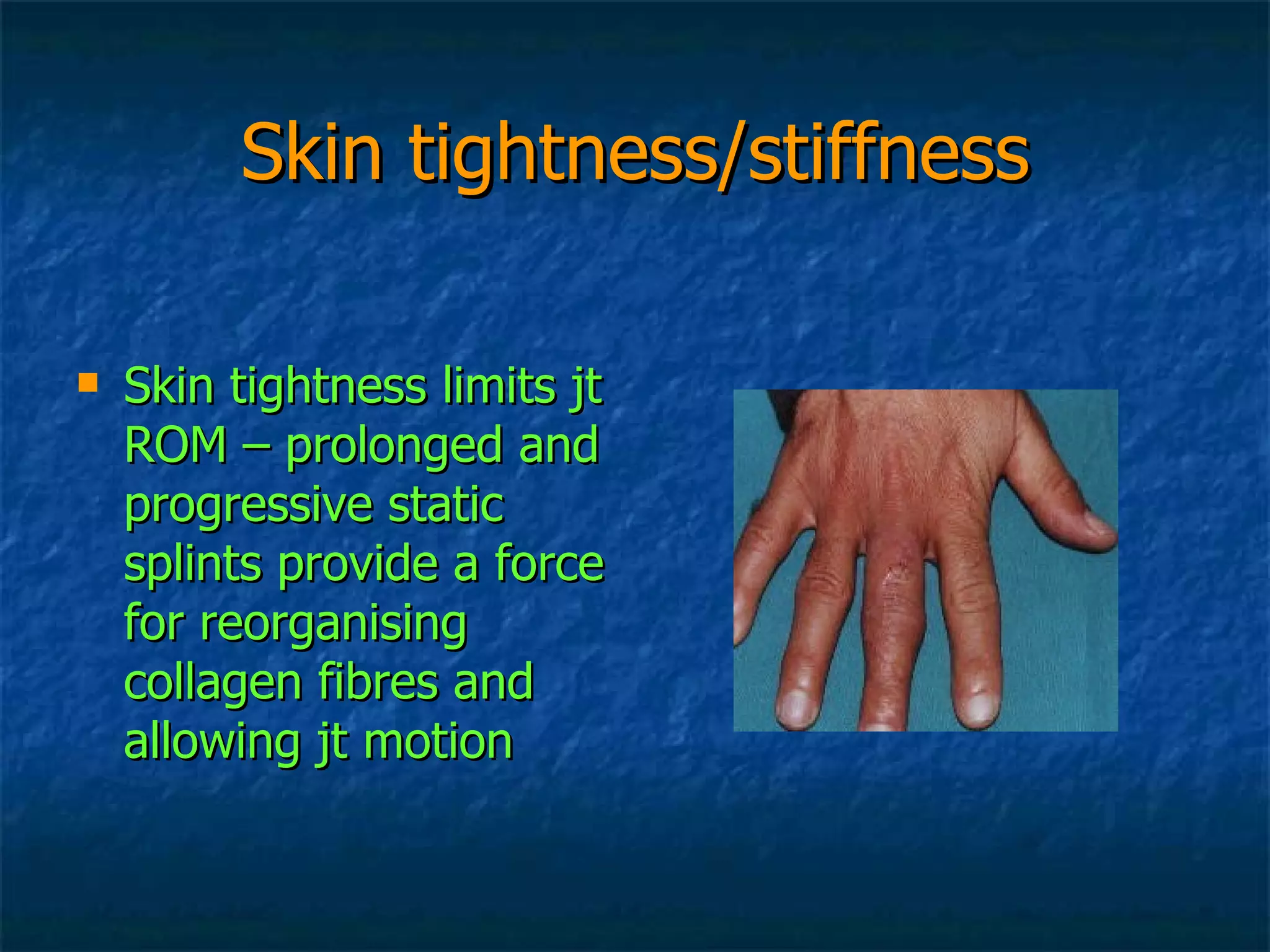 Hand Therapy - Stiff Small Joints Of The Fingers | PPT