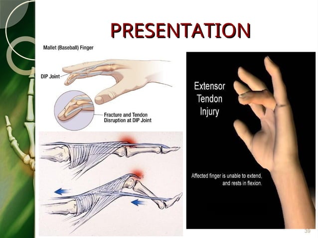 HandTrauma-1_0(1) at manufacturing company.ppt | First Aid | Injuries