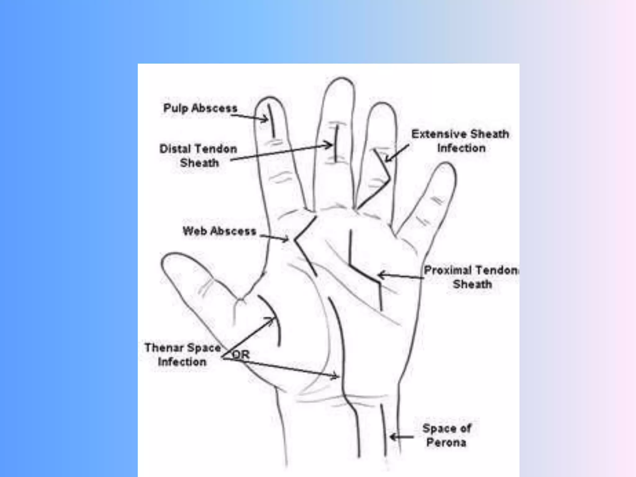 Hand trauma - soft tissue injuries overview ,principles of management ...