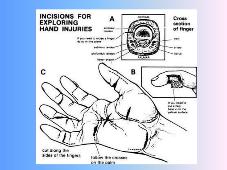 Hand trauma - soft tissue injuries overview ,principles of management