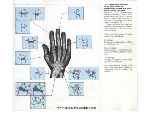 Hand wrist x rays /certified fixed orthodontic courses by Indian dental ...