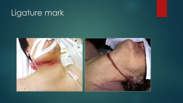 HANGING IN HISTOPATHOLOGY BY STEPHEN ANTO.pptx