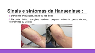slide com o tema da doença hanseníase em pdf | PDF