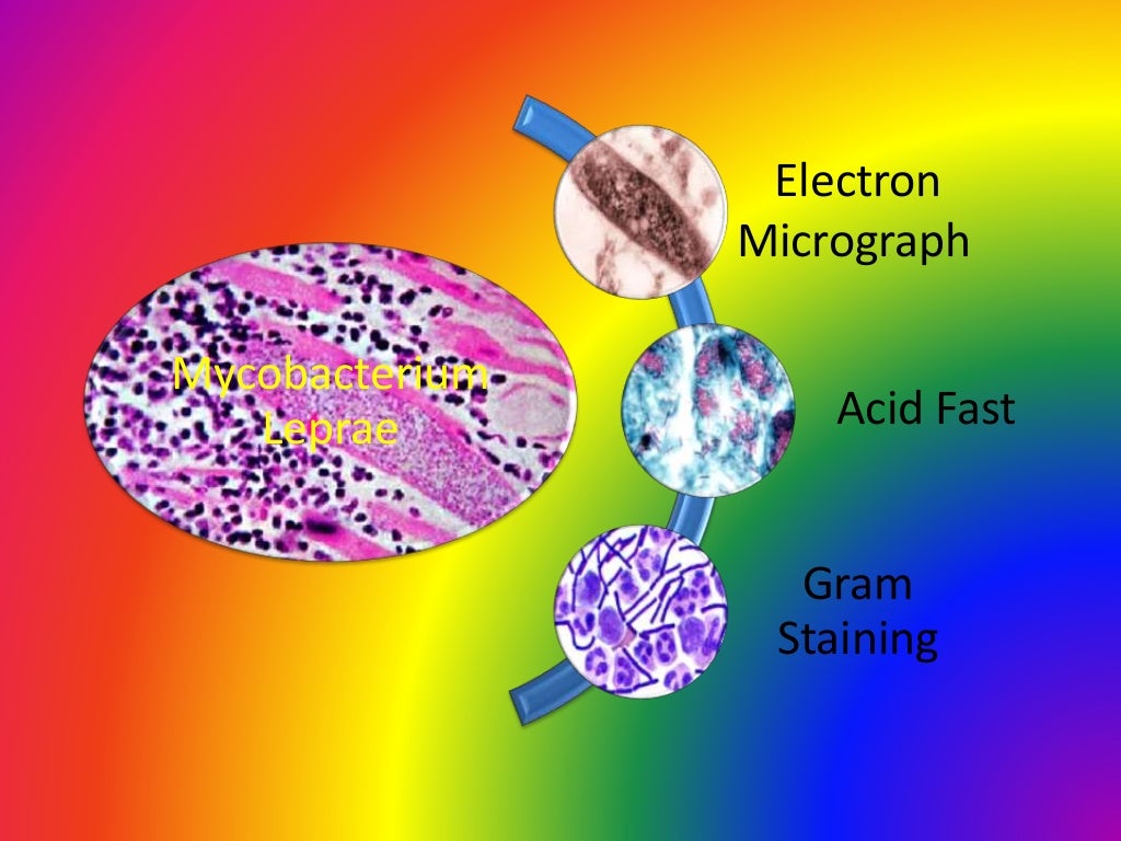 Hansen disease medical microbiology presentation by Ruth Naomi Manuel